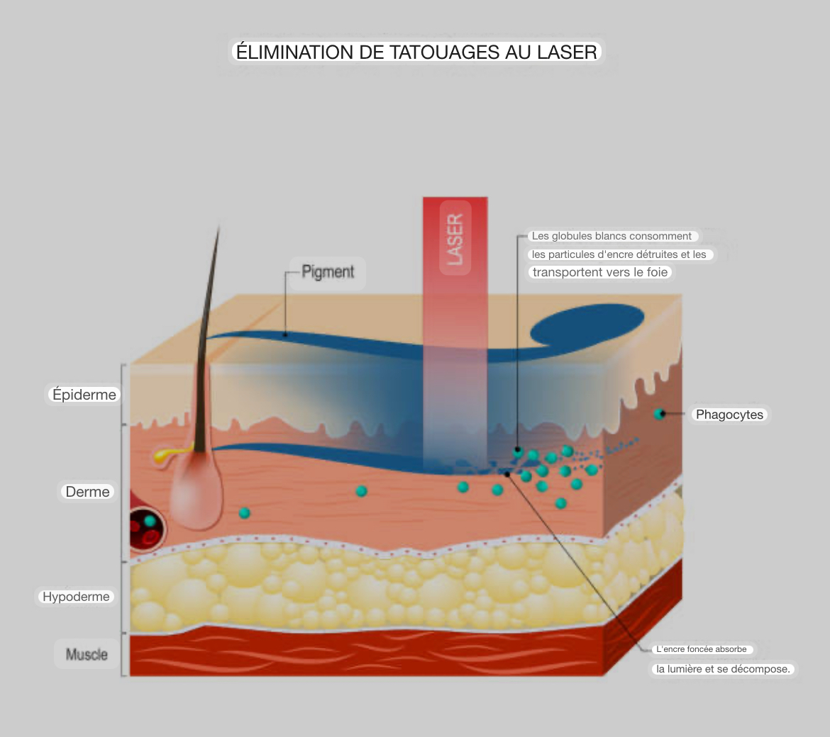 Détatouage progressif Lyon 8 - Laser doux & efficace|Yiskah Tattoo